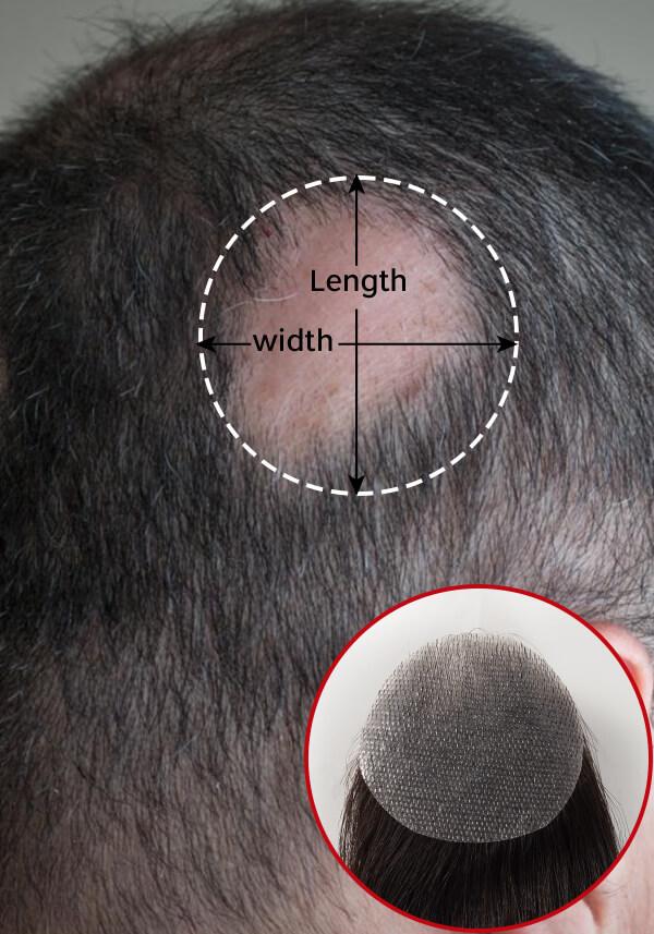 Hair Patch for Men |Hairloss Solution for Spot Hair Loss