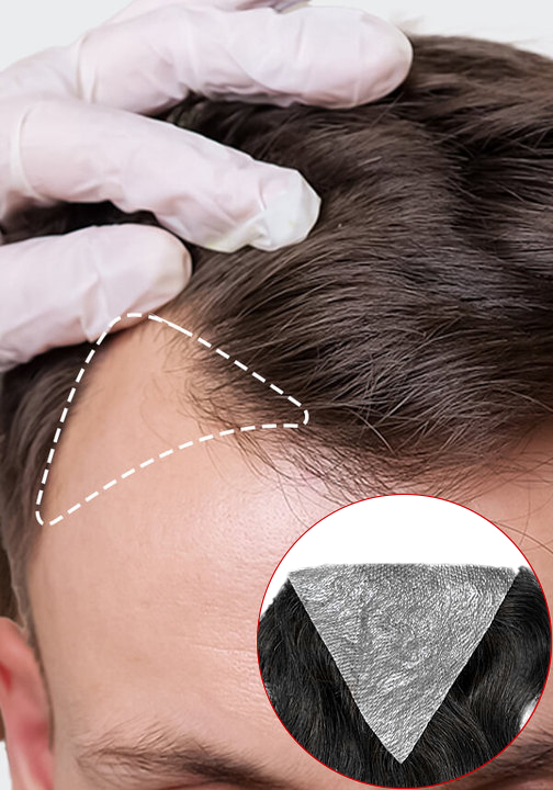 Temple Hair Patch for Men | Hair System Unit for Bald Spot