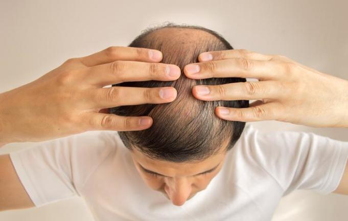 Genetic Hair Loss Meaning Causes Treatments And More